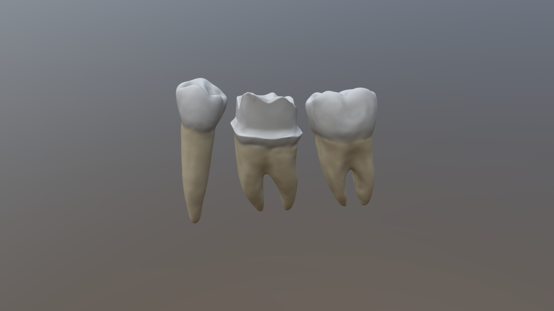 Crown Prep 4 Interproximal - 3D model by SDEO [bda1d49] - Sketchfab