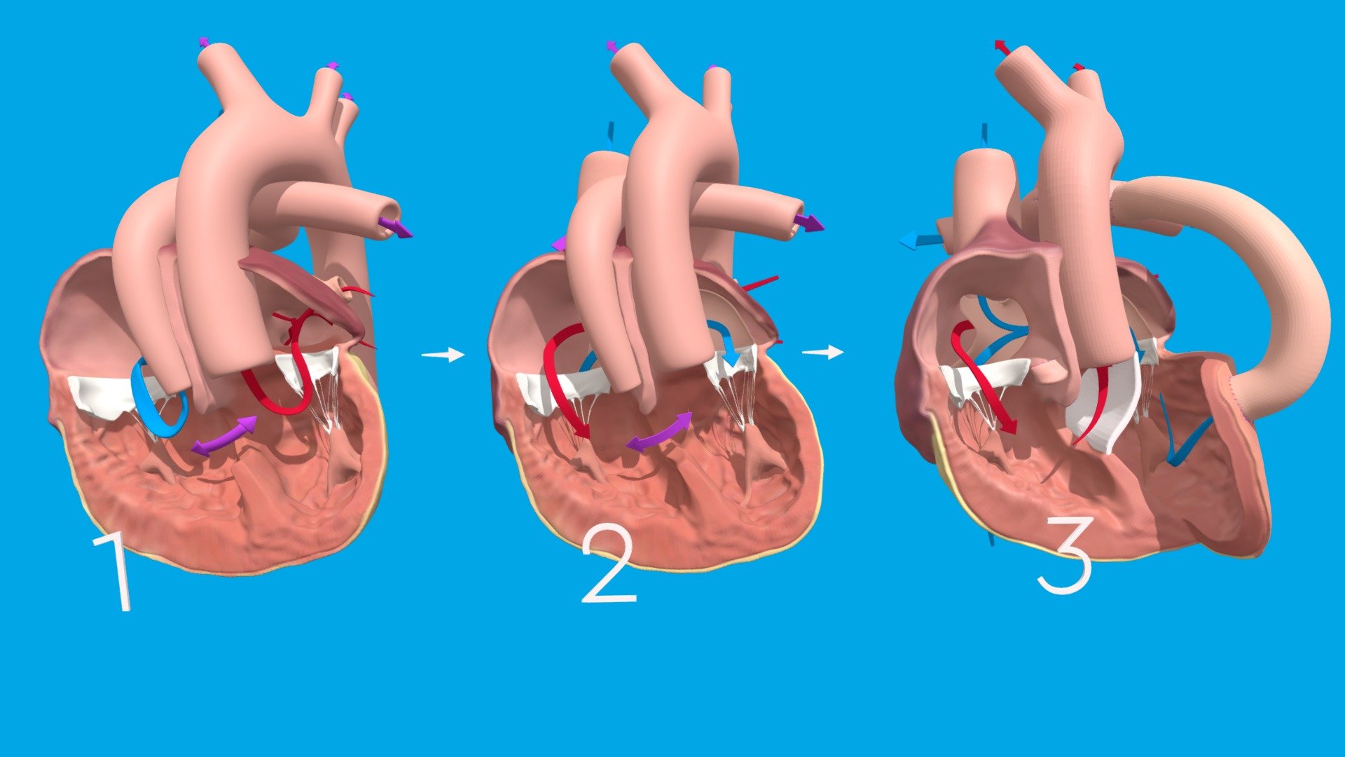 Double Switch Procedure with VSD - 3D model by Children's Hospital ...