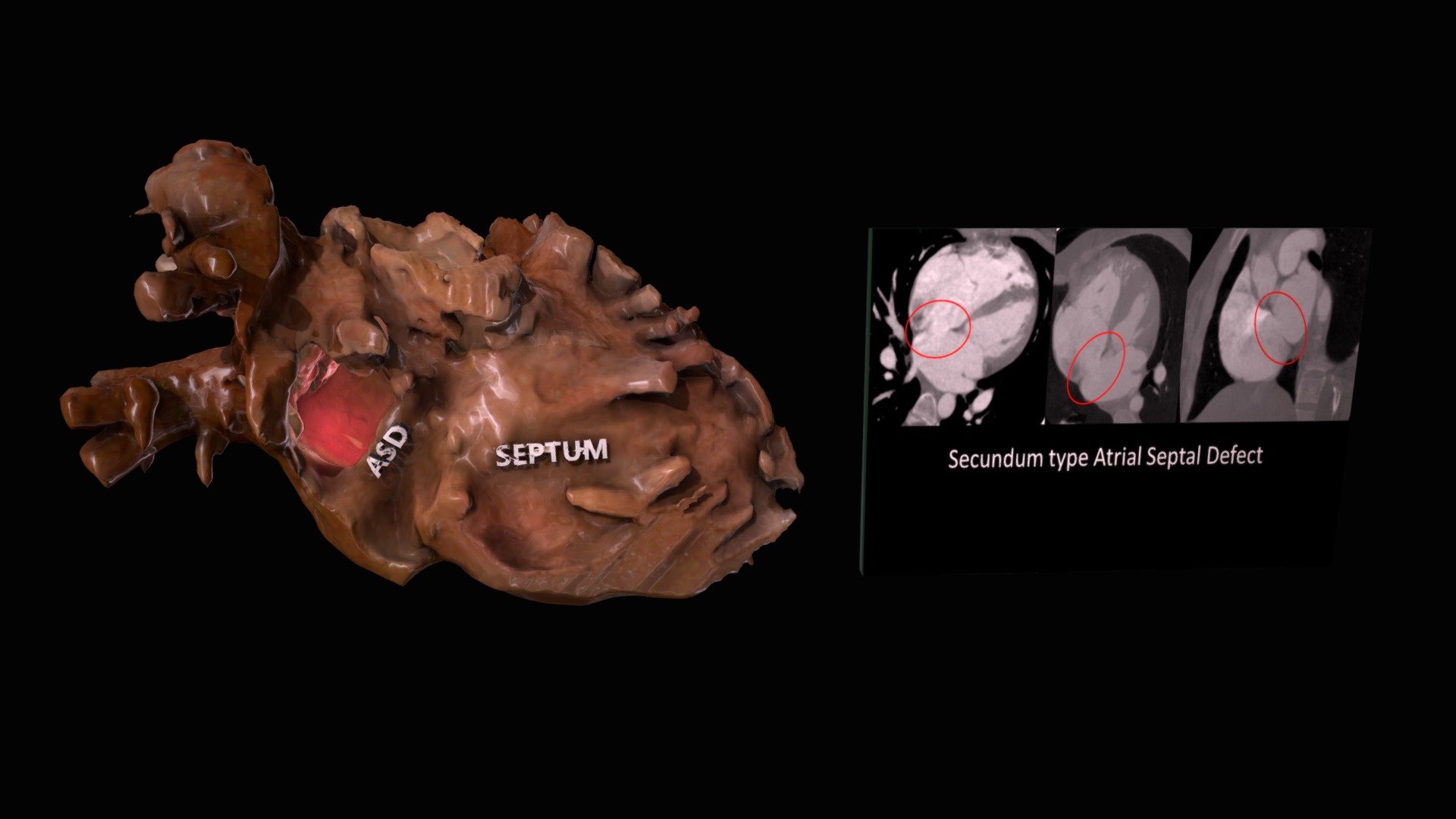 Secundum Type Atrial Septal Defect - 3D model by tl0615 [bf5e993 ...