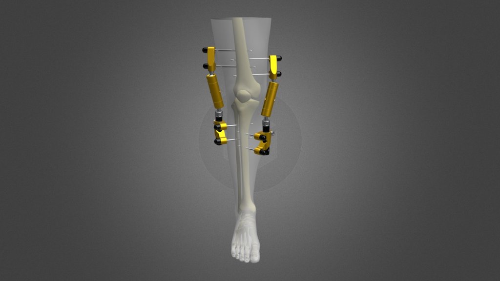 Arthrosave Placement Evaluation - 3D model by Wiedemeijer [bfbe555 ...