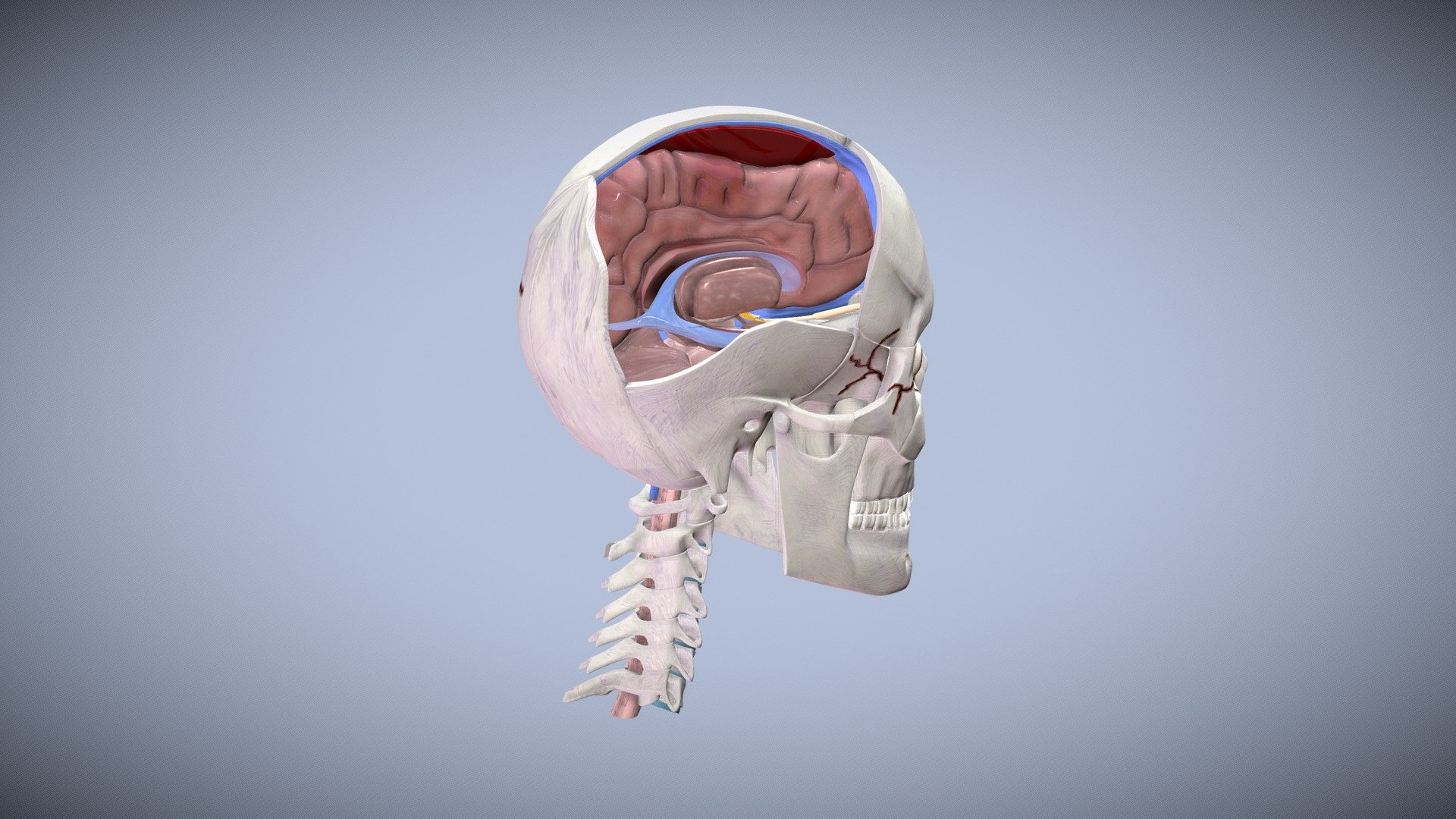 Subdural Hematoma - Download Free 3D model by CVallance (@cvallance01 ...