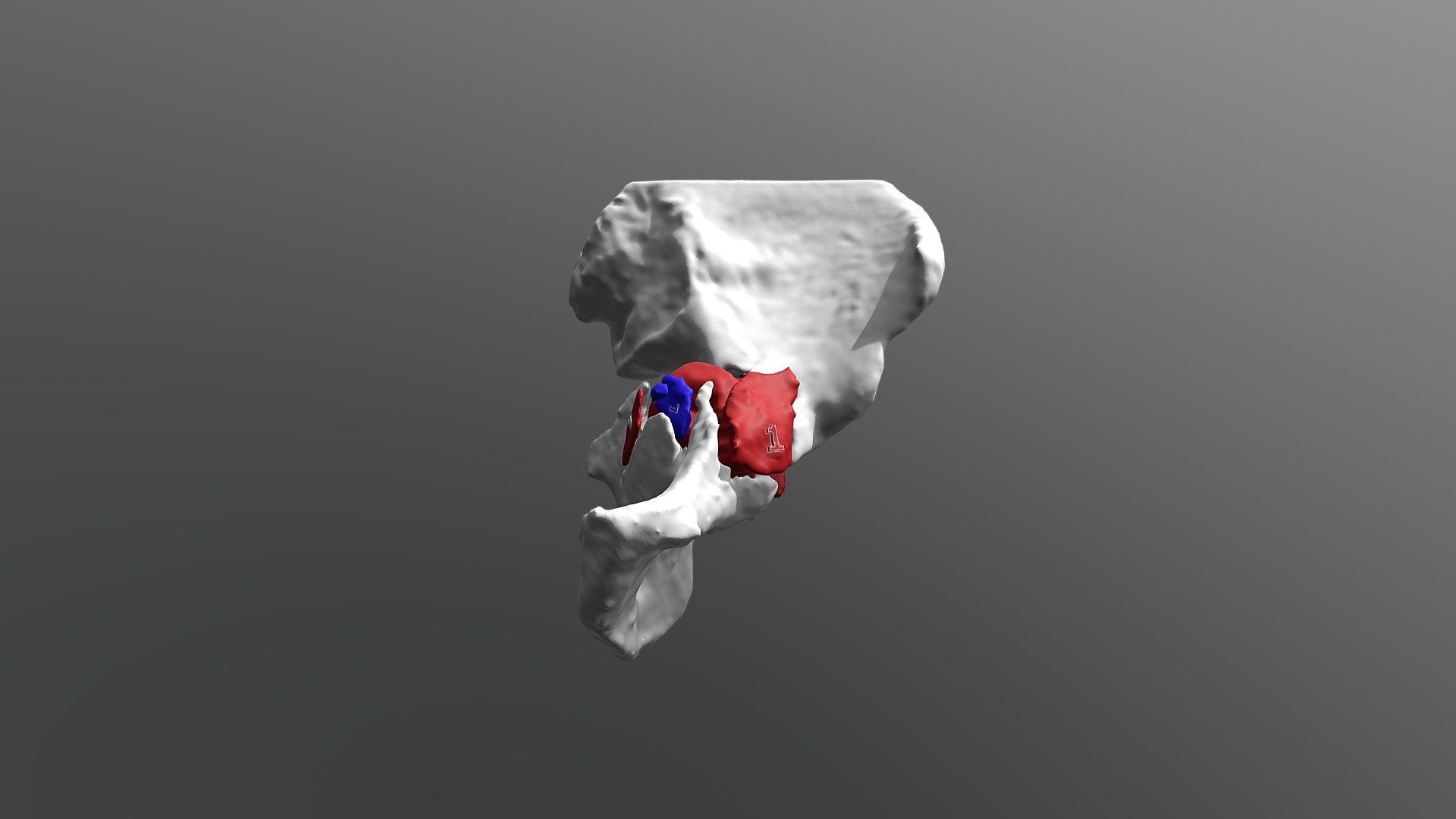 Acetabular fracture of the hip - 3D model by valchanov [c1bdf88 ...