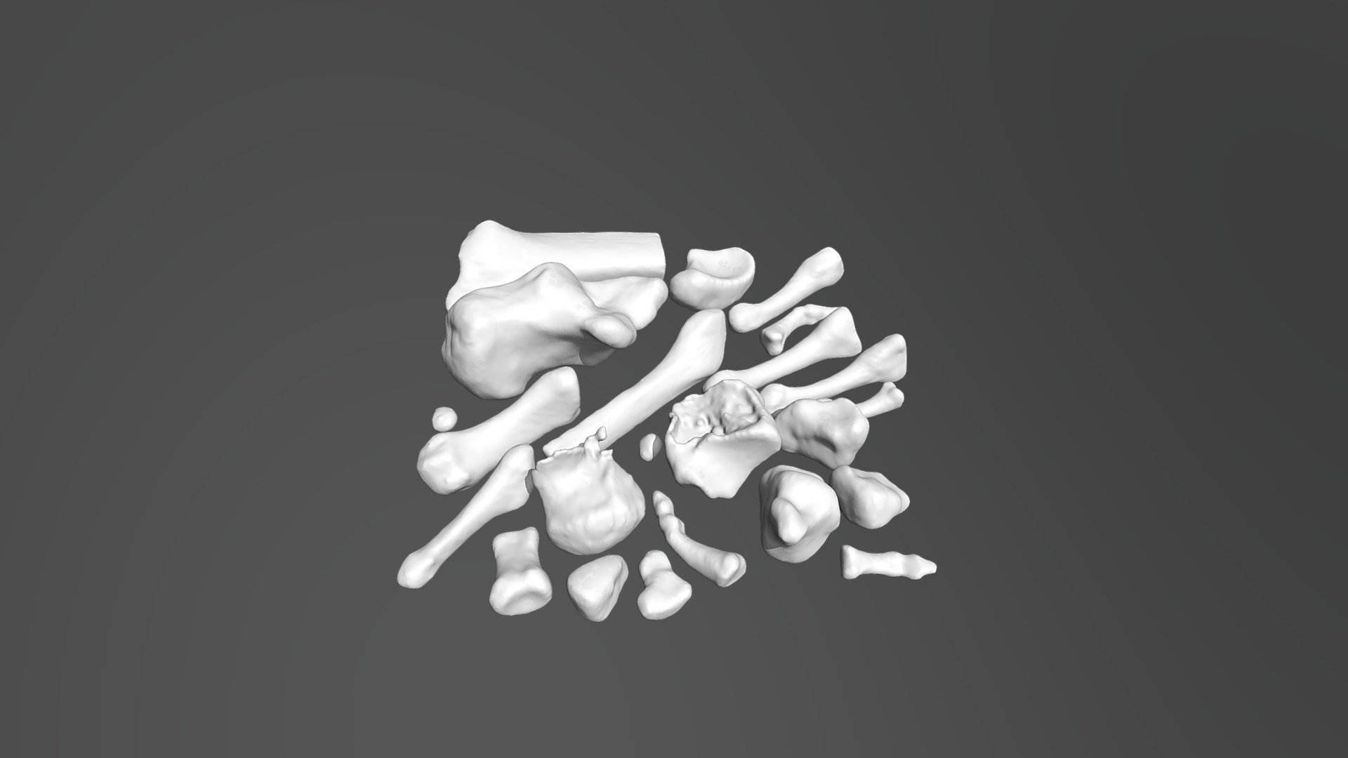 Fracture of the Talus for 3D printing - Buy Royalty Free 3D model by ...
