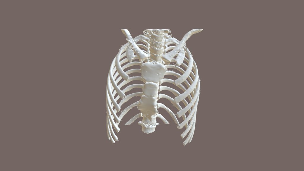 Pectus Excavatum - 3D model by jonbra [c1f46fd] - Sketchfab