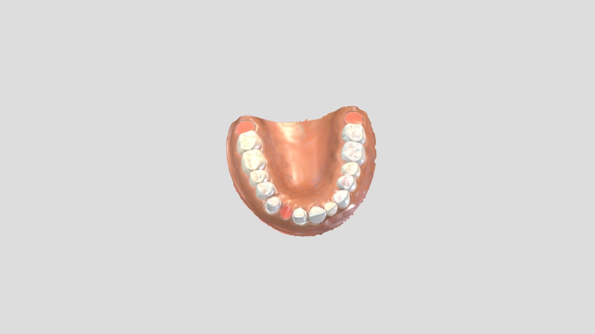 #9-11 All Ceramic (Zirconia) FPD Preparation - 3D model by ramiammoun ...