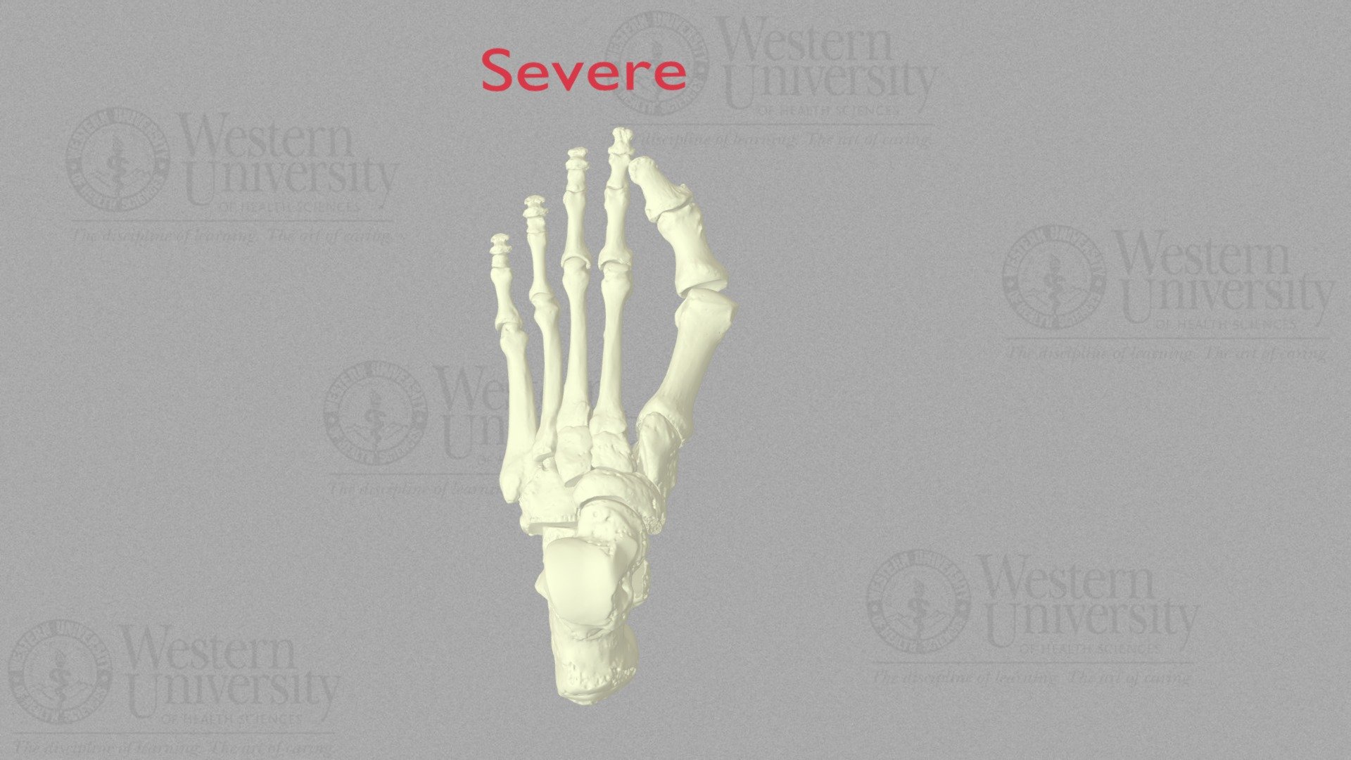 Hallux Valgus - Rectus to Severe - 3D model by WesternU3D [c3f1c9e ...