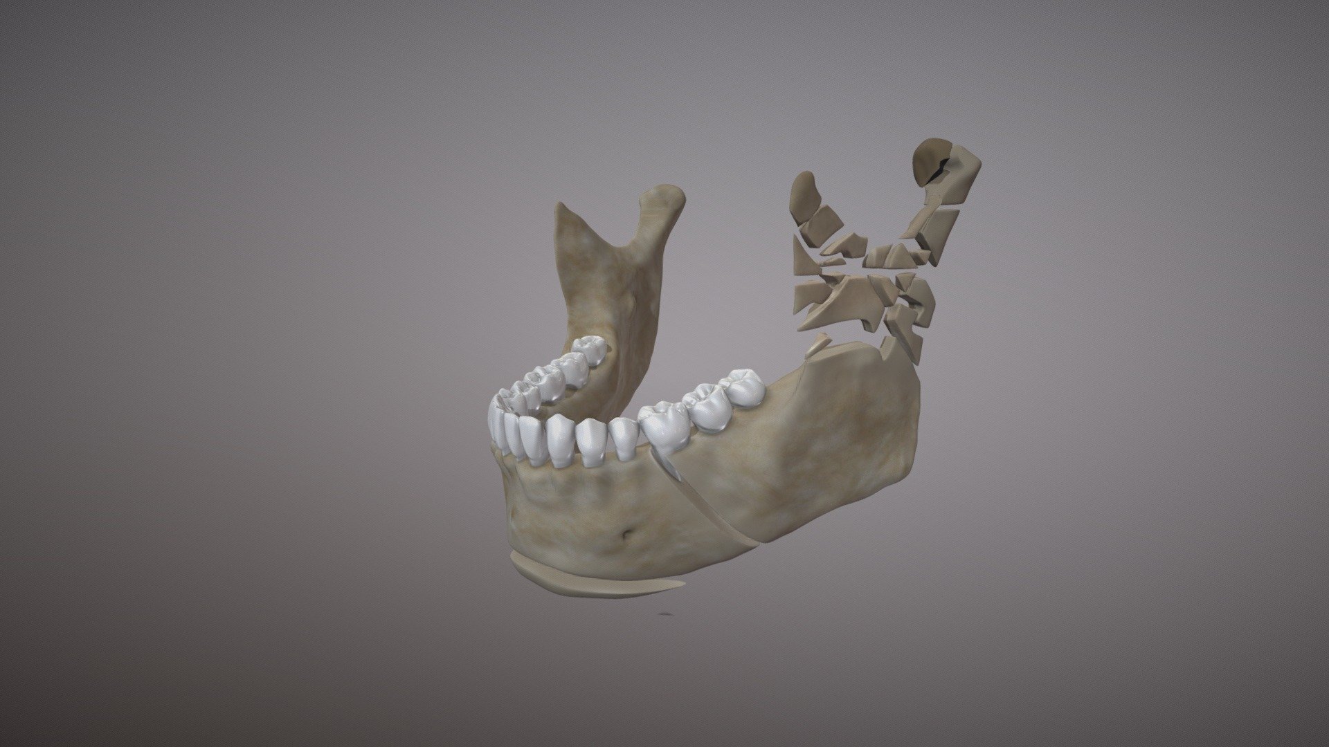 Fracture Classification- Complete - 3D model by University of Dundee ...