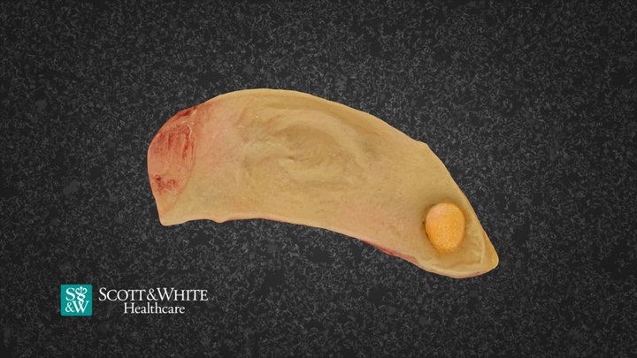 Gallstone 3D models - Sketchfab