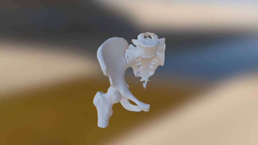 Acetabular Fracture - sku 234 - 3D model by orto3d [c495af2] - Sketchfab