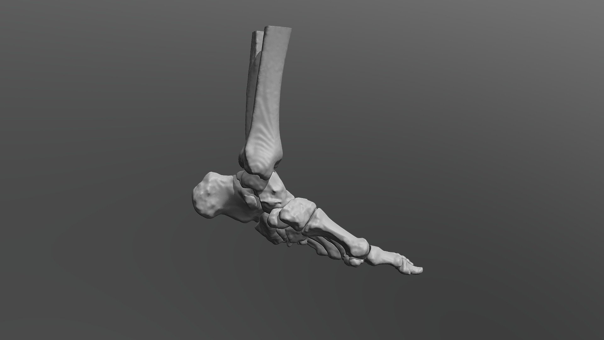 Foot of Charcot. Rocker-bottom deformity. - Download Free 3D model by ...