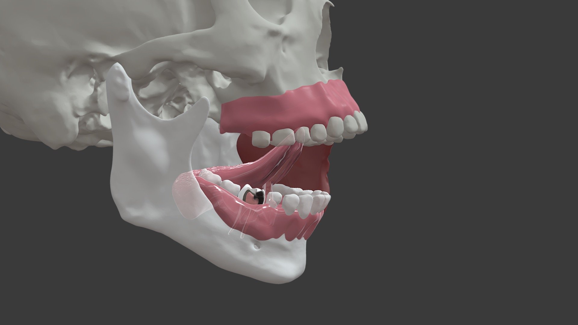 Stage 2 - Mandibular Infection pathway 4 - 3D model by University of ...