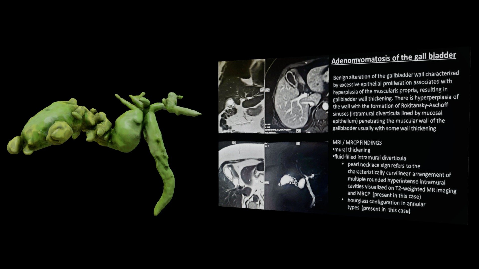 Adenomyomatosis of the gall bladder - 3D model by tl0615 [c5b758c ...