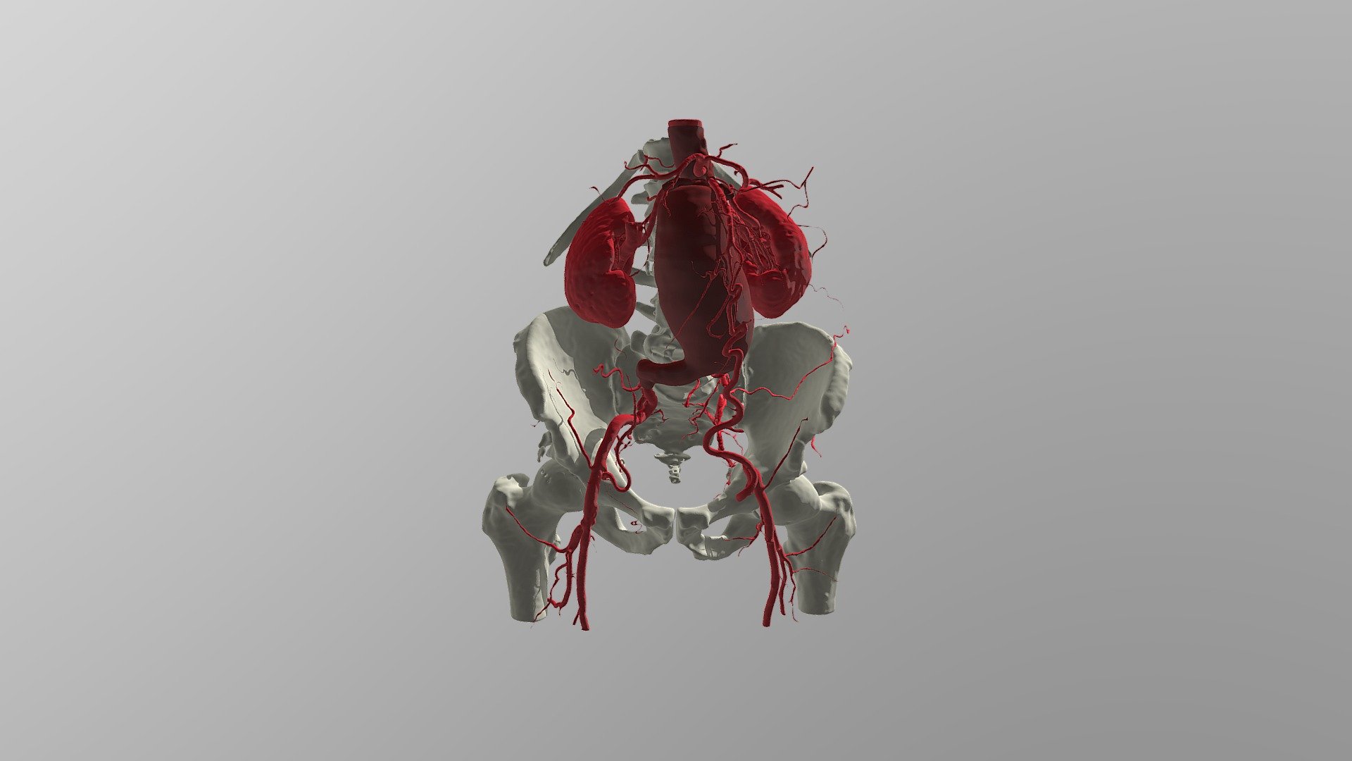 Subrenal aneurysm of the abdominal aorta - 3D model by valchanov ...