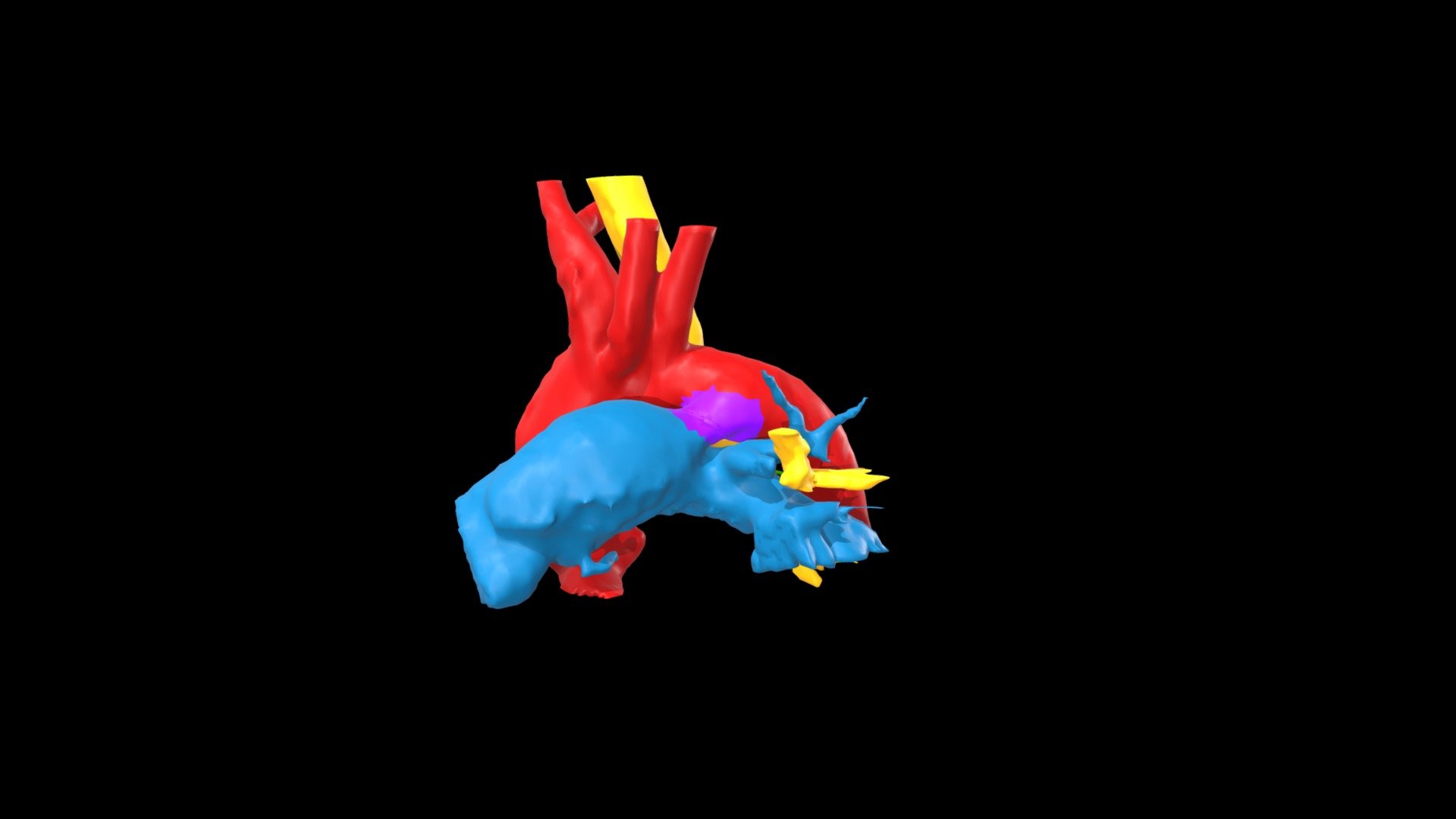 Left superior lobar bronchus obstruction - 3D model by Lincoln Wong ...