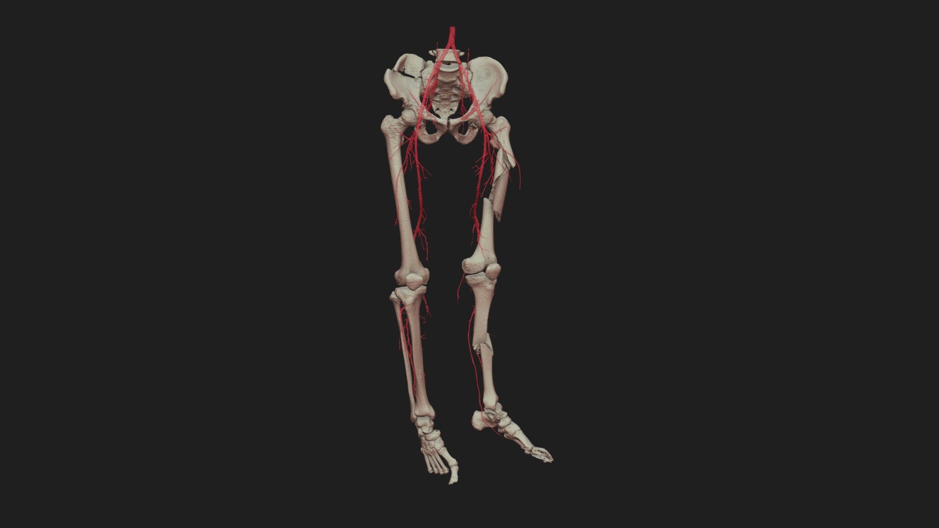cotm fracture - 3D model by 3dqlabstanford [c6f6615] - Sketchfab