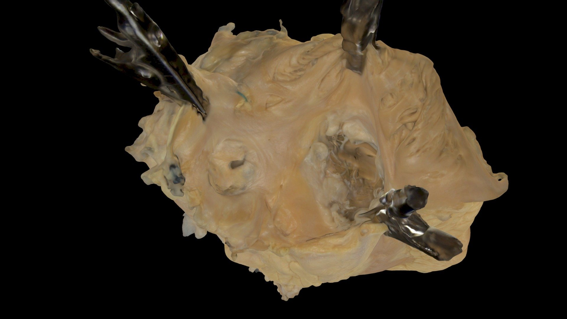 Right Atrium Human Heart Model ASD - Download Free 3D model by ...