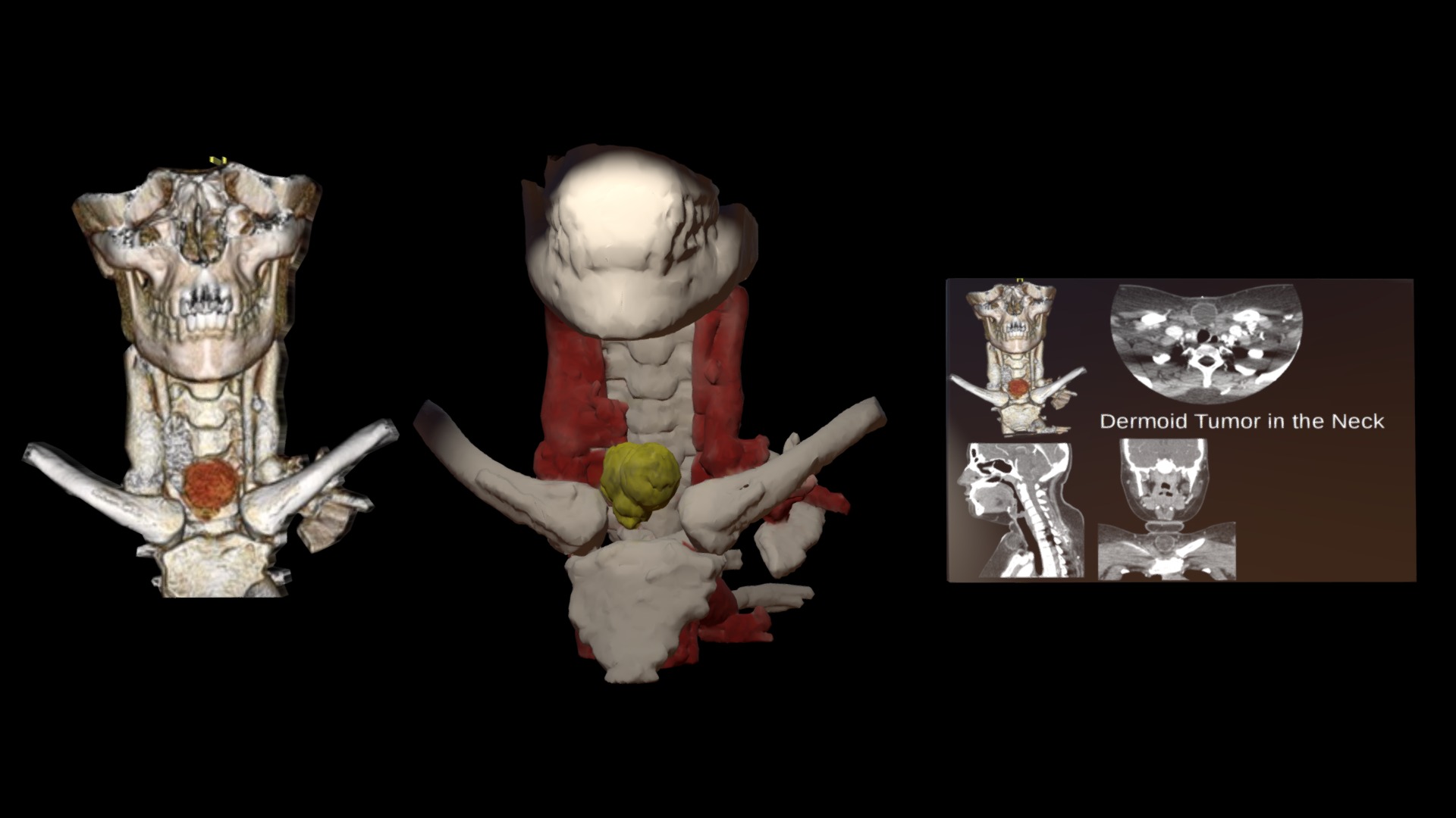 Dermoid Cyst in the Neck - 3D model by tl0615 [c7c2d8c] - Sketchfab