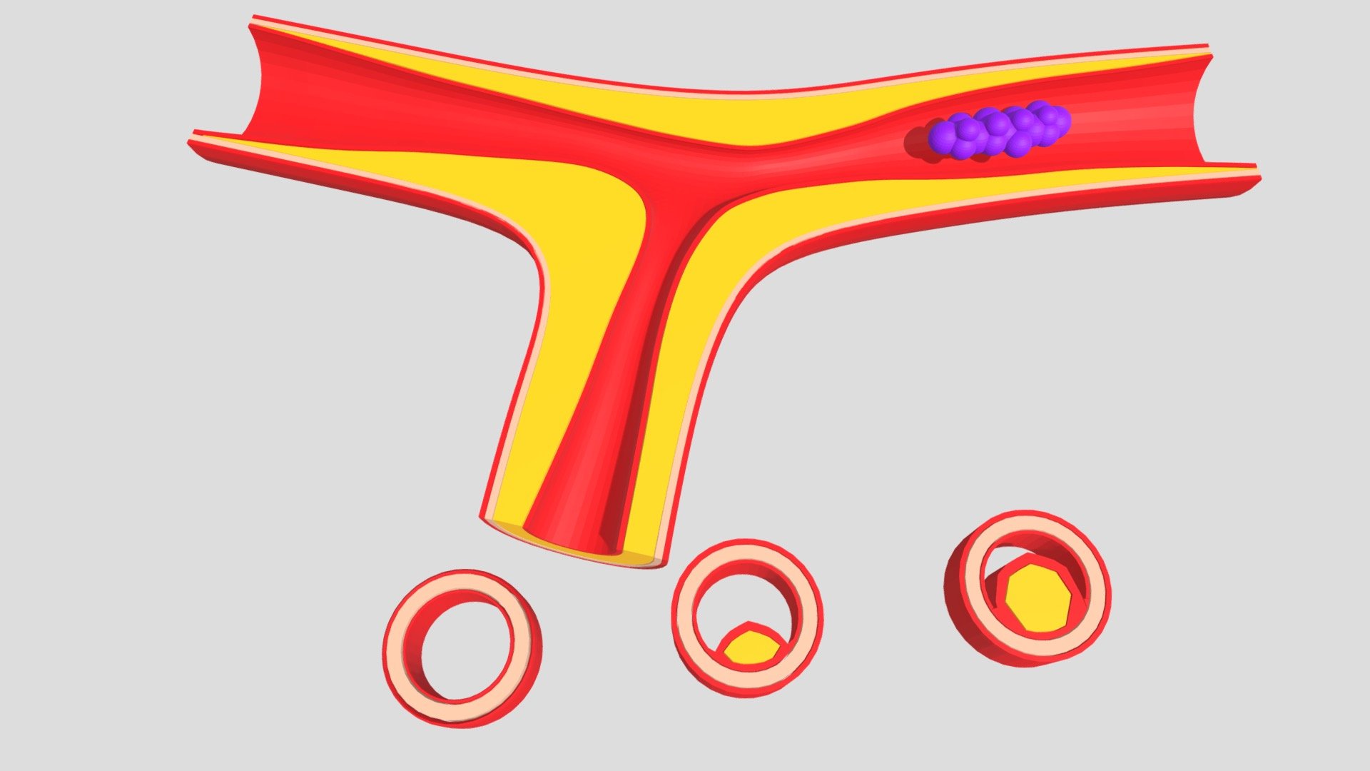 Atherosclerosis Educational Model - 3D model by Federico Espinola MD ...