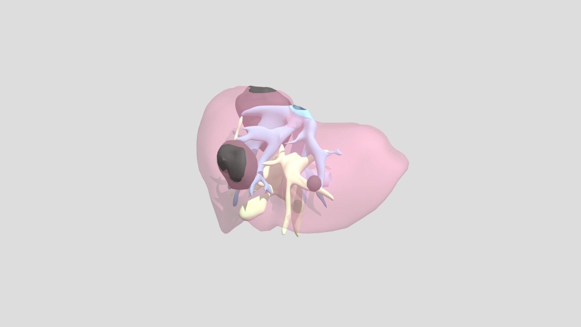 Multifocal HCC - 3D model by Denys.F (@Deny44) [c835ef7] - Sketchfab