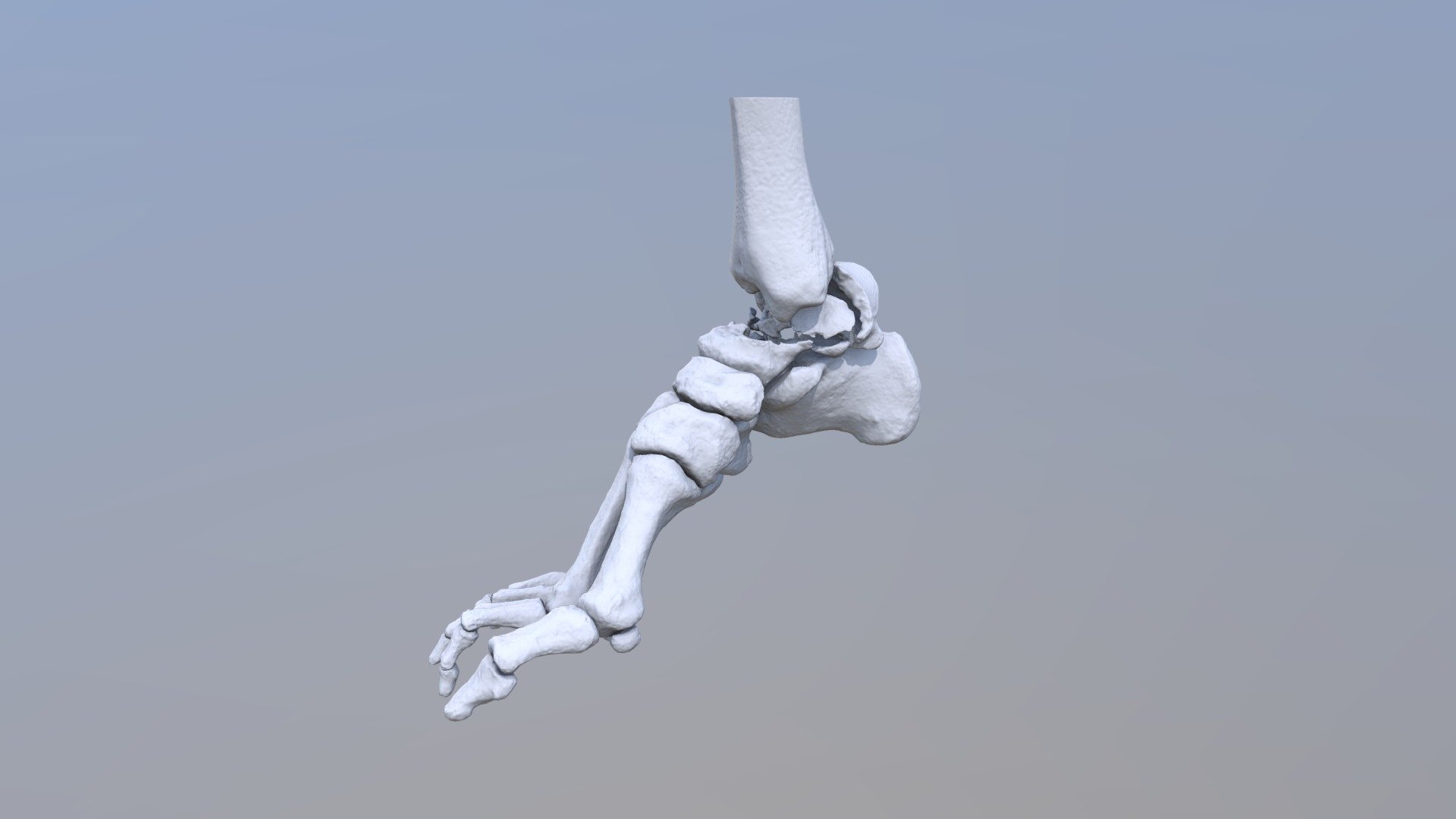 Talus fracture - 3D model by Innowise: 2D/3D Design and Software ...
