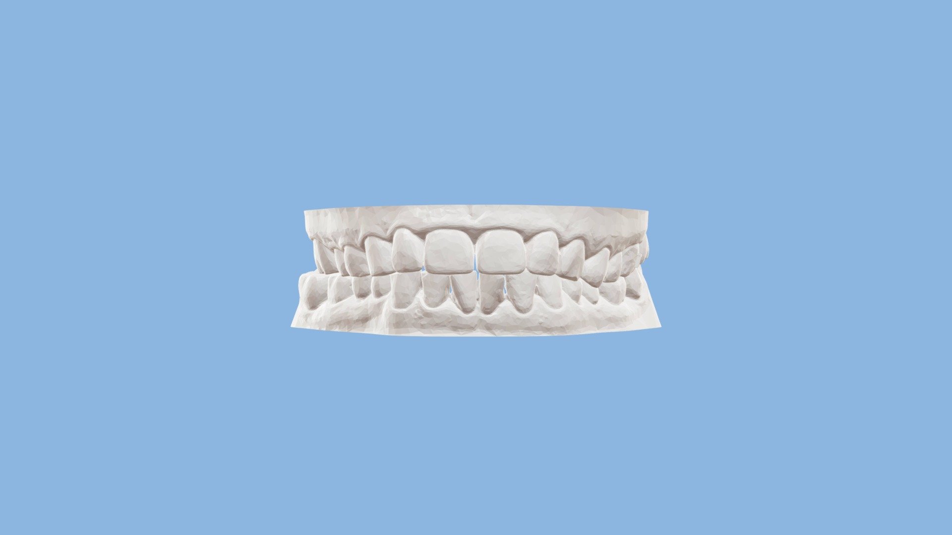 U3 - 3D model by ODL OrthoLab (@Odlortho) [c94fa17] - Sketchfab