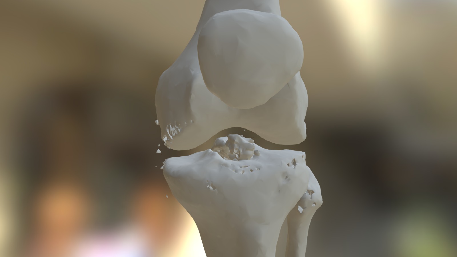 Knee - Proximal Tibia Fracture sku 027 - 3D model by orto3d [c9ed55b ...