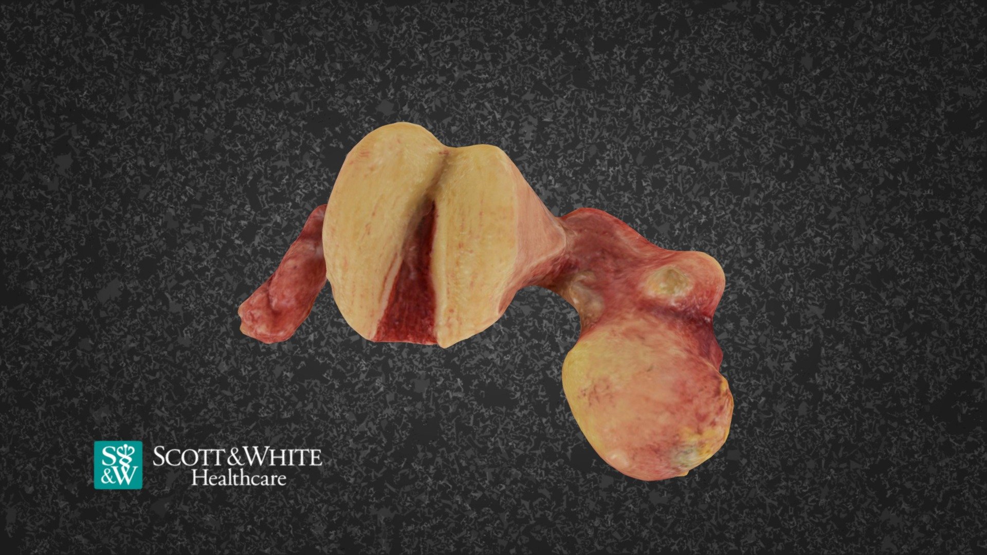 Uterus Fibromyomata - 195261 - 3D model by Scott & White Moulage ...