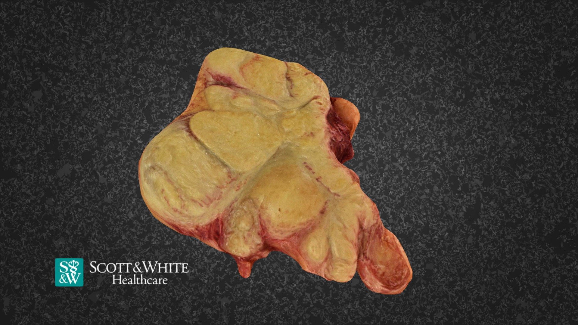 Fibroid Abdominal Wall pt 2 149166 - 3D model by Scott & White Moulage ...