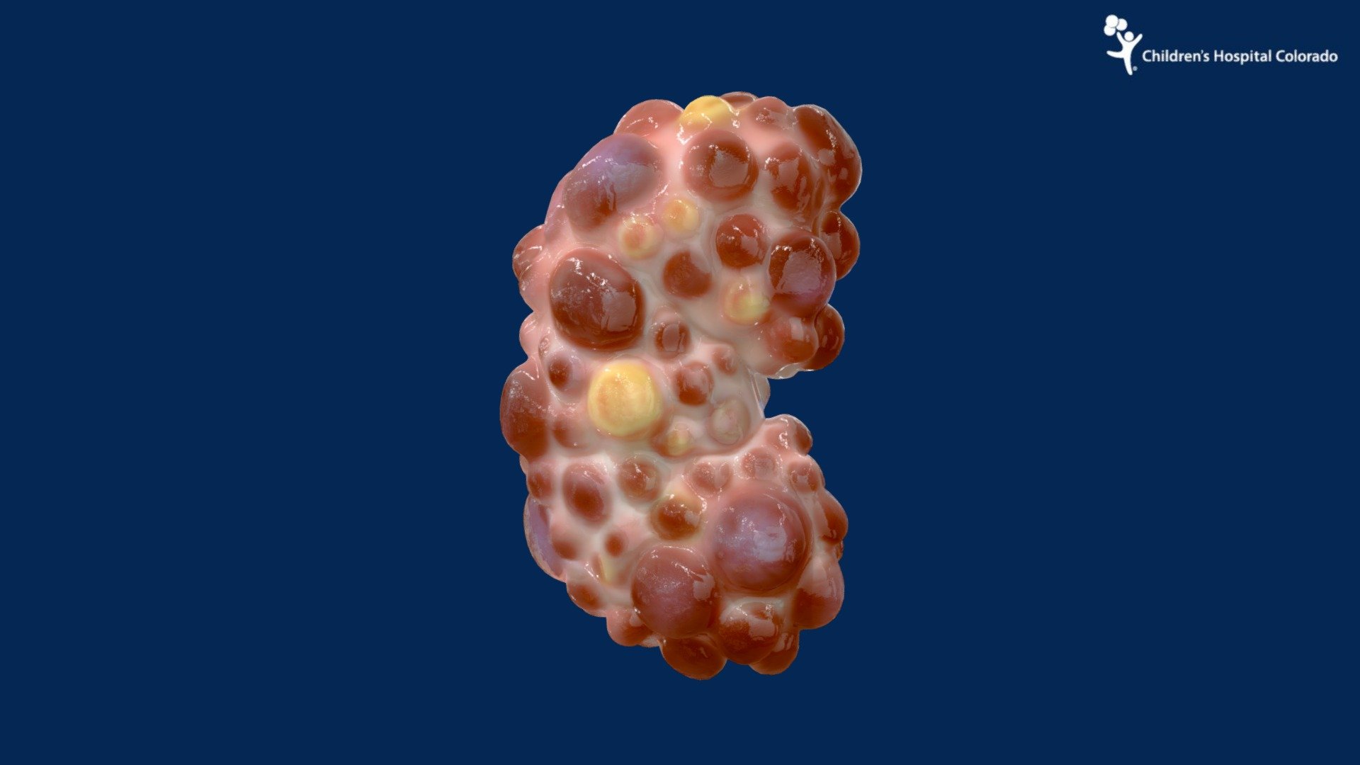 Polycystic Kidney - 3D model by Children's Hospital Colorado Medical ...