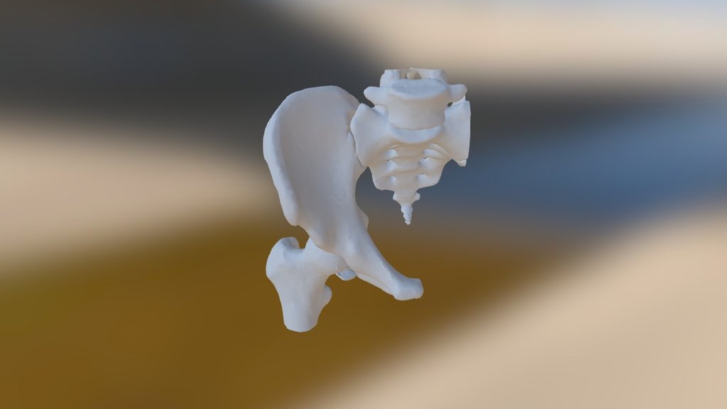 Acetabular Fracture - sku 246 - 3D model by orto3d [cb7cda4] - Sketchfab