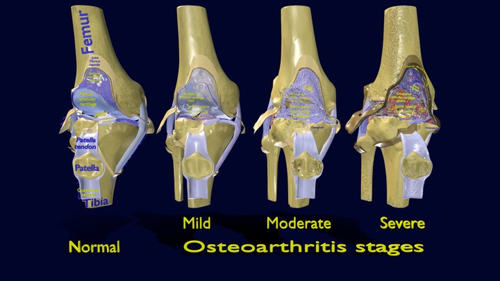 Patella 3D models - Sketchfab