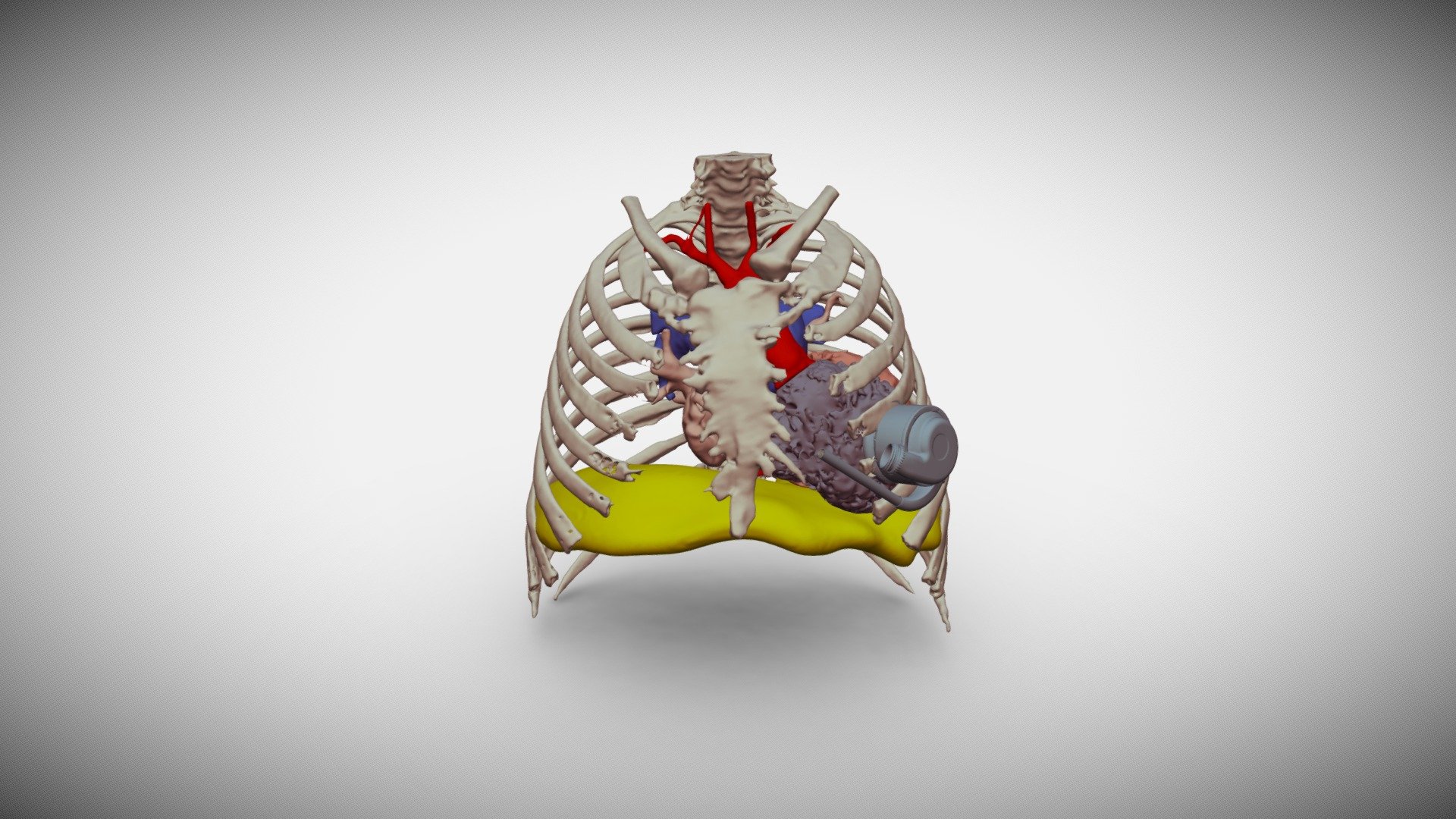 HM3 implantation after Mustard procedure - 3D model by Imre J. Barabás ...