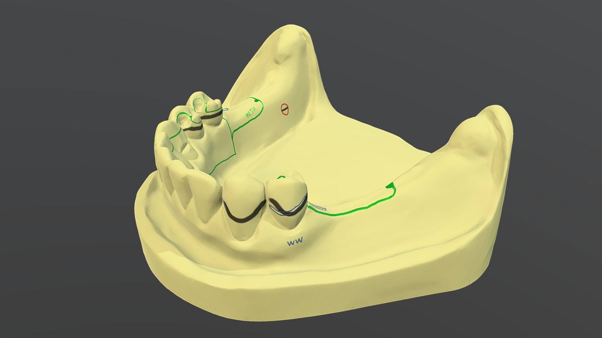 Kennedy Class I RPD Design - VCU - 3D model by ramiammoun [cc299ce ...