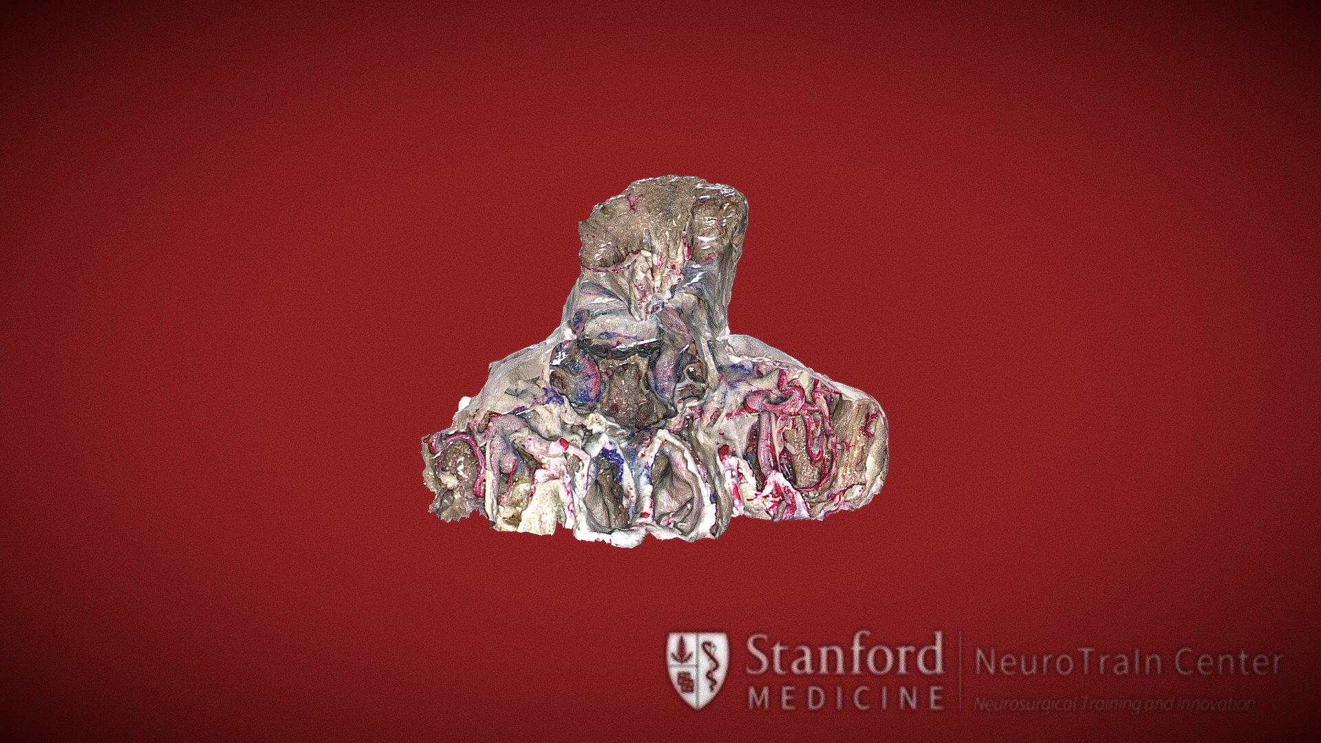 Sphenoid Sinus and Bilateral Maxillary Sinus - 3D model by vv (@verav ...