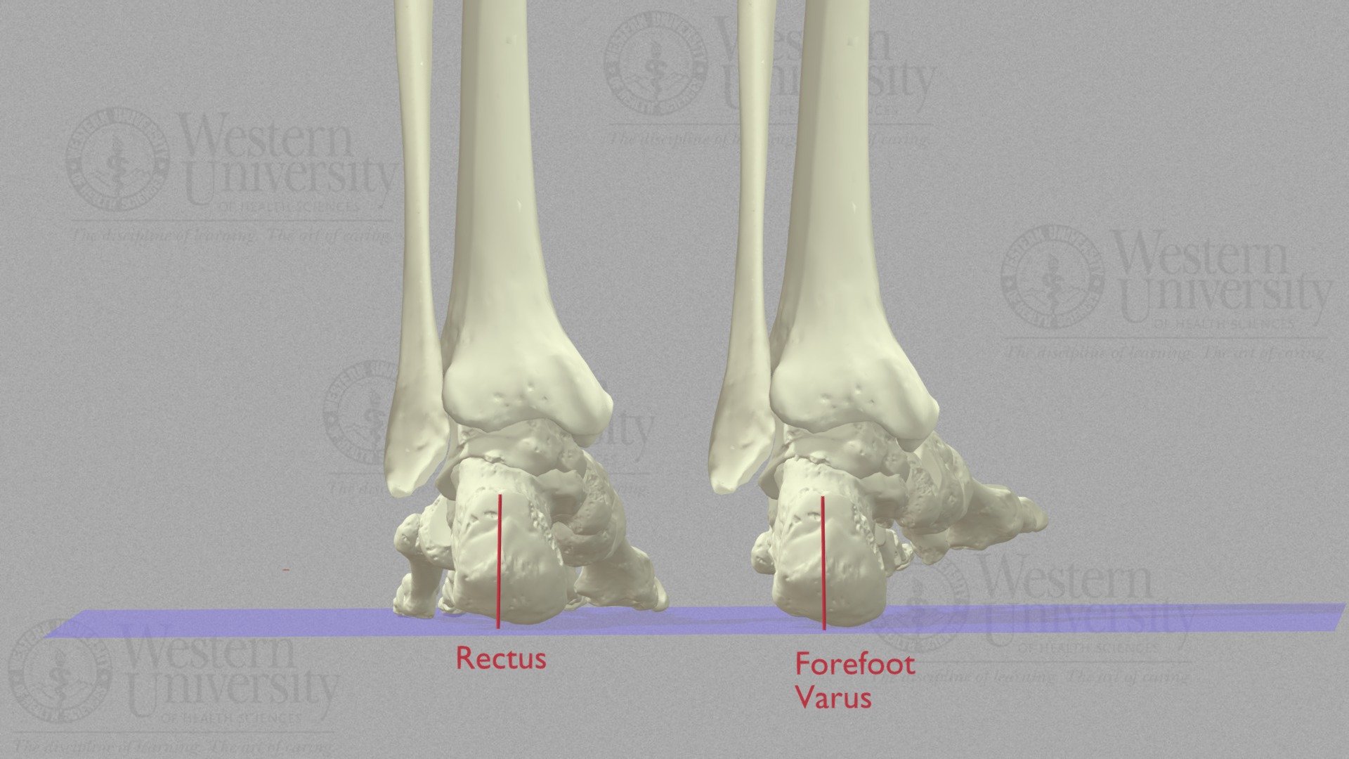Forefoot Varus -Full Compensation - 3D model by WesternU3D [cd33f64 ...