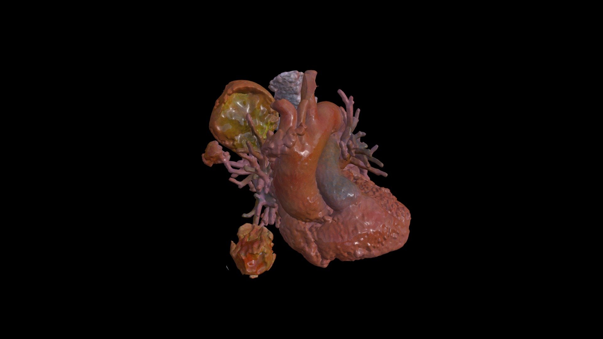 Pulmonary Abscess - 3D model by tl0615 [ce71937] - Sketchfab