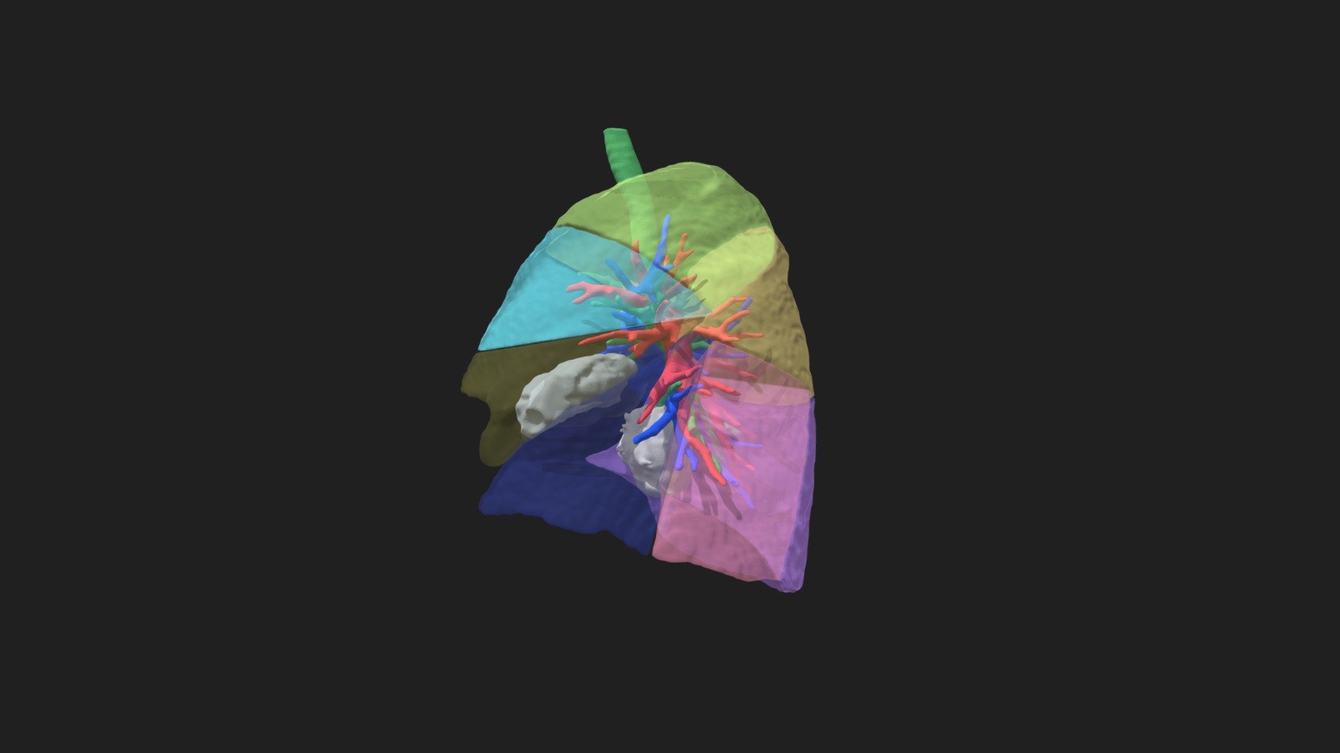 MTS of osteosarcoma - 3D model by thorac.topsurgery [ce9d7d2] - Sketchfab