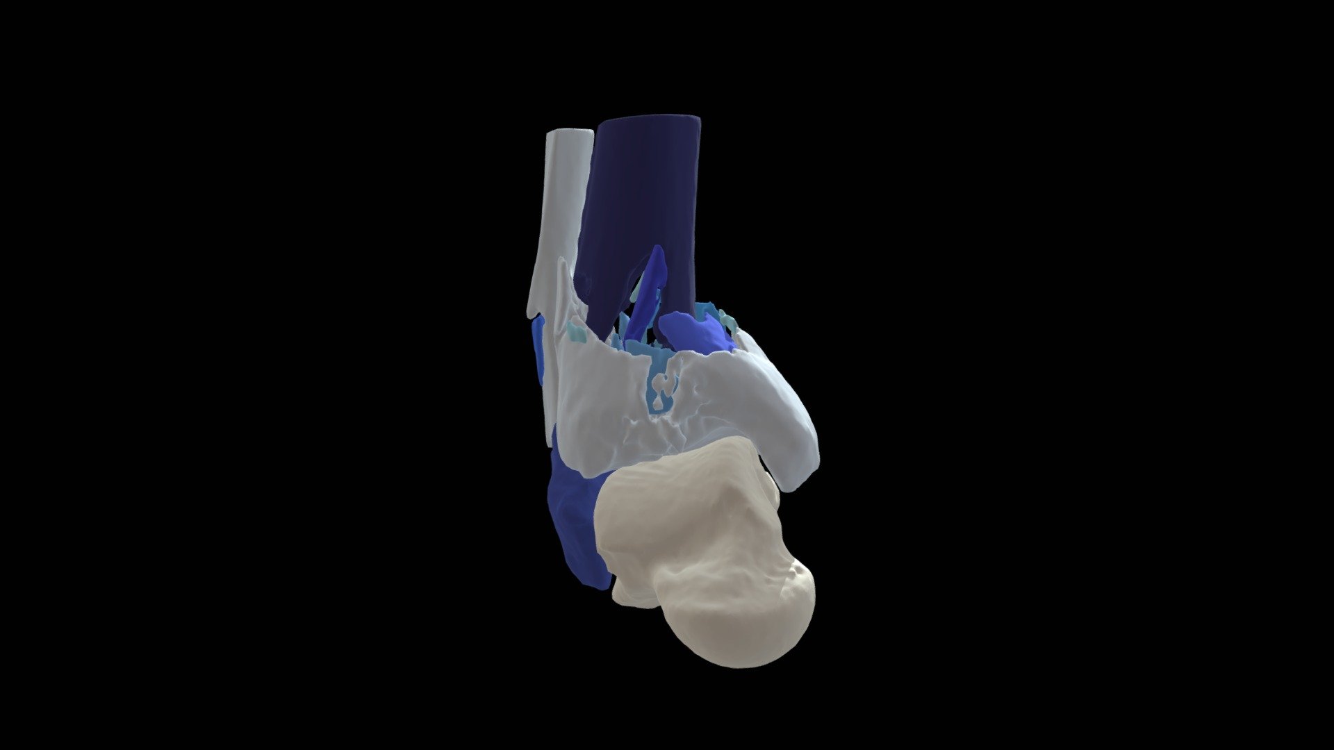 Session 4.01 | Pilon Fracture - MIPO vs ORIF|CGN - Download Free 3D ...