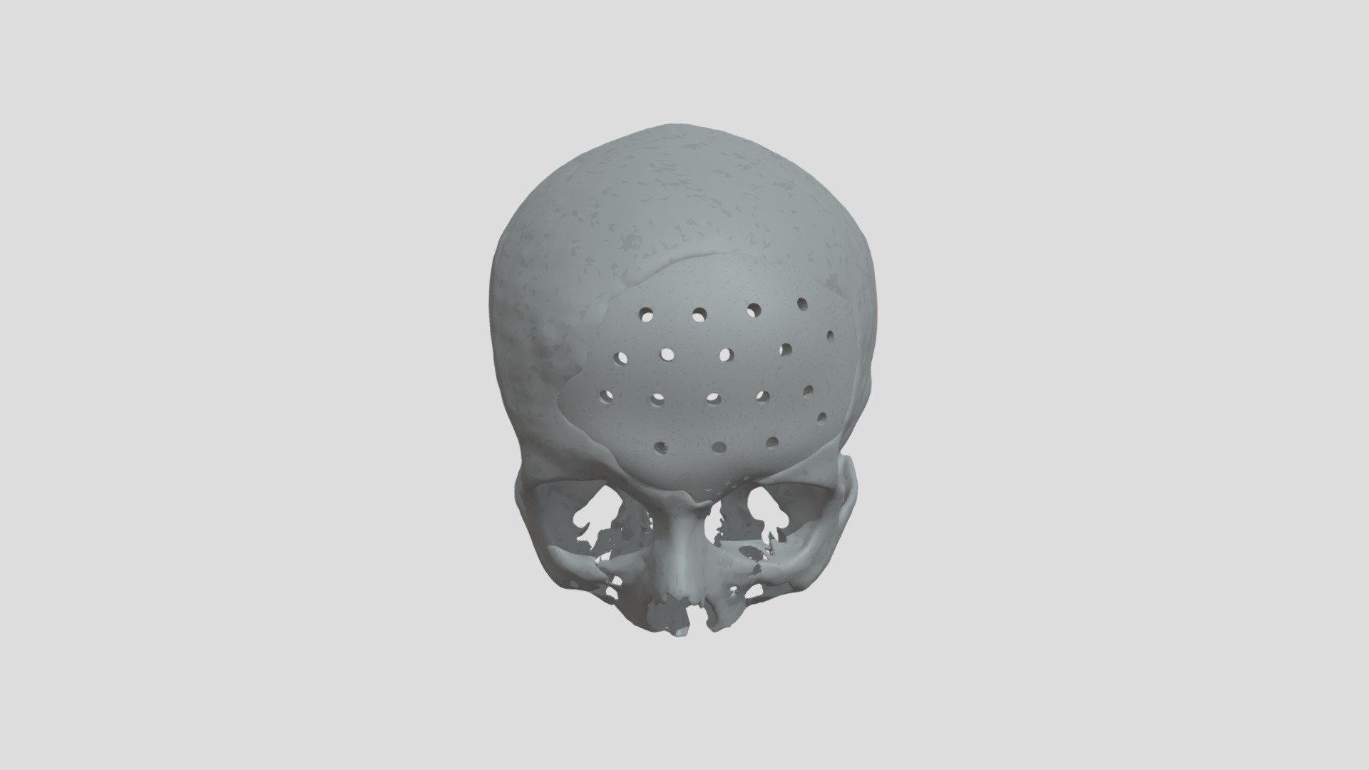 Skull Prosthesis - 3D model by houmamesambassamlala2009 [cf40911 ...