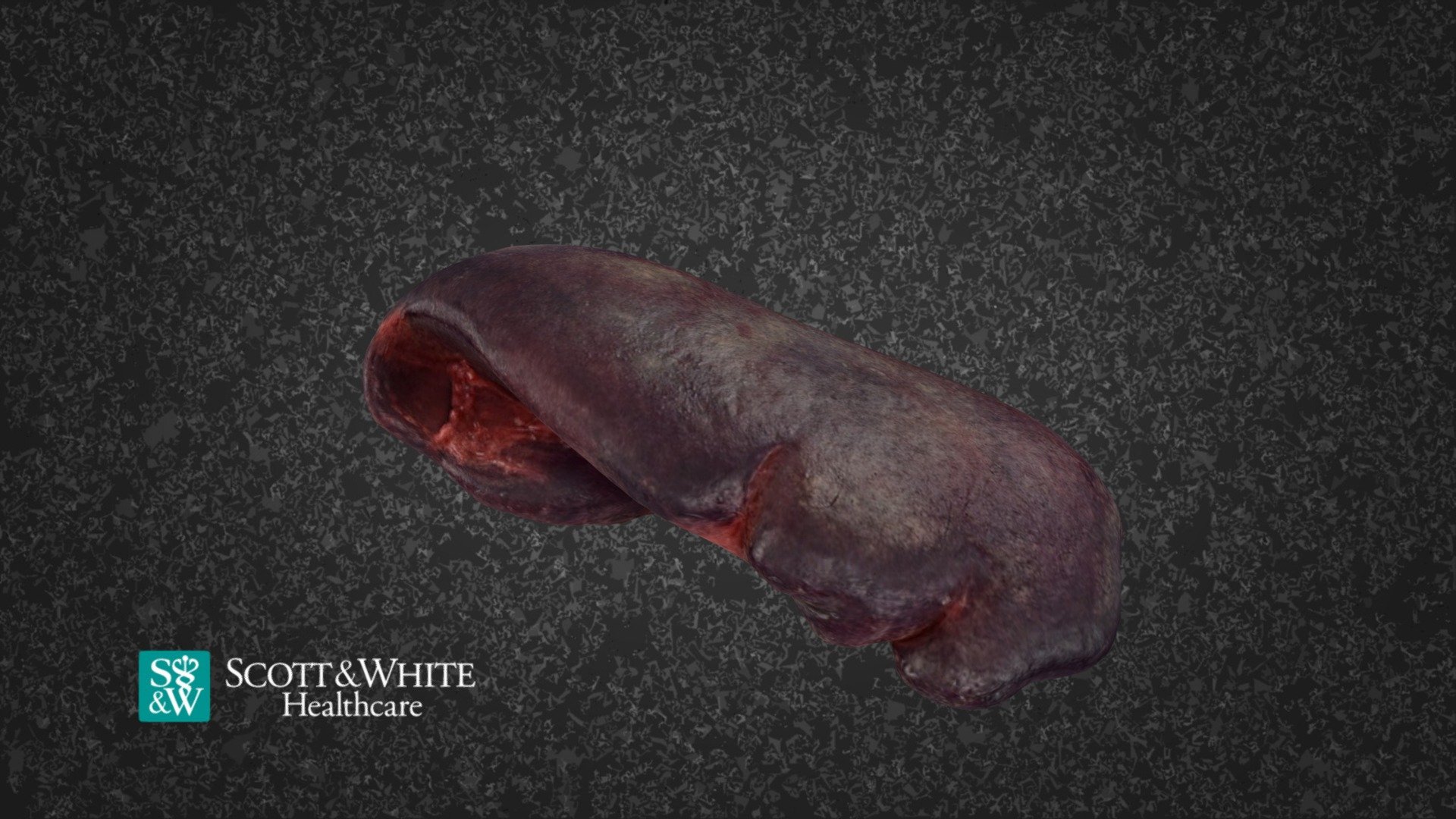 Lymphosarcoma Spleen 21030 - 3D model by Scott & White Moulage Project ...