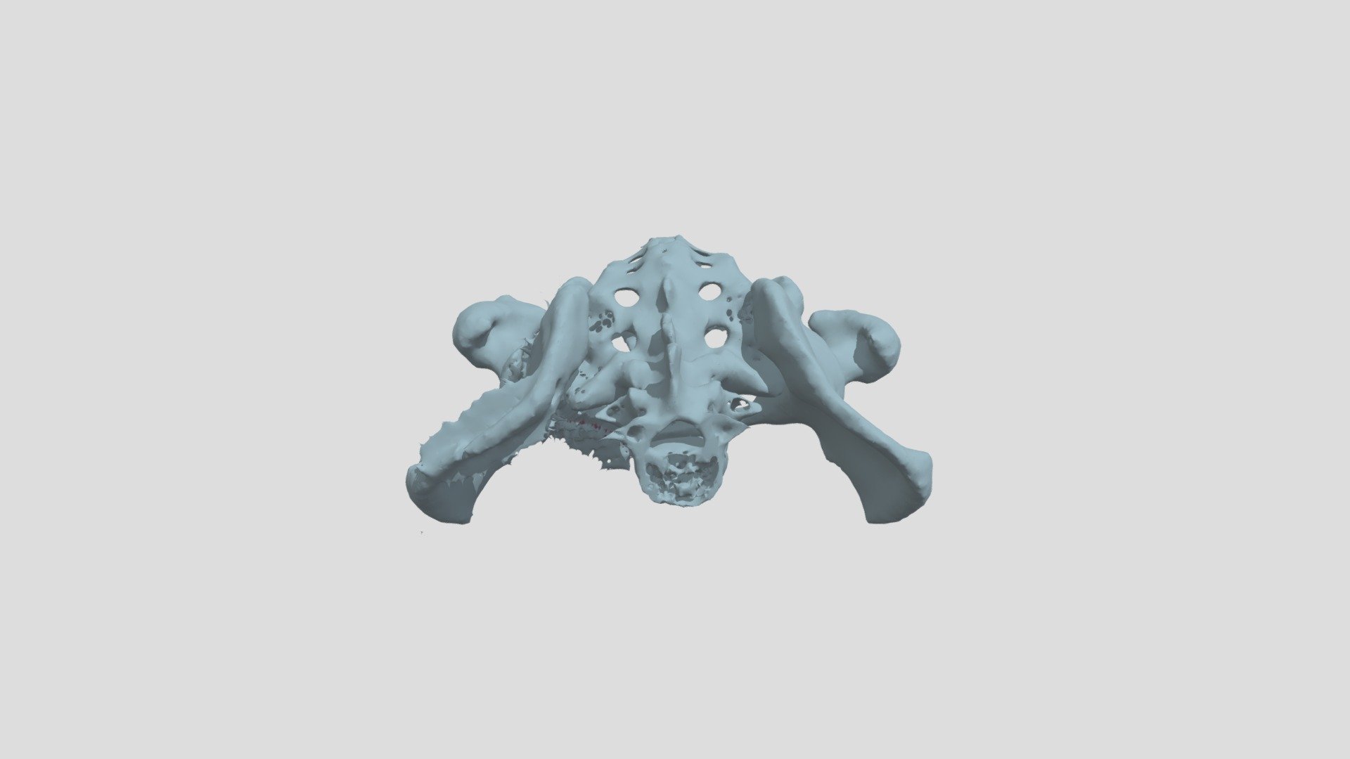 Bones and Hardware Segmentation - 3D model by emily.buchanan [cfa695c ...