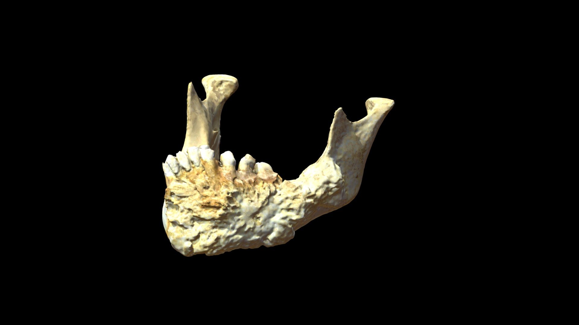 Mandible with Osteosarcoma (VCU_3D_2944) - 3D model by Virtual Curation ...