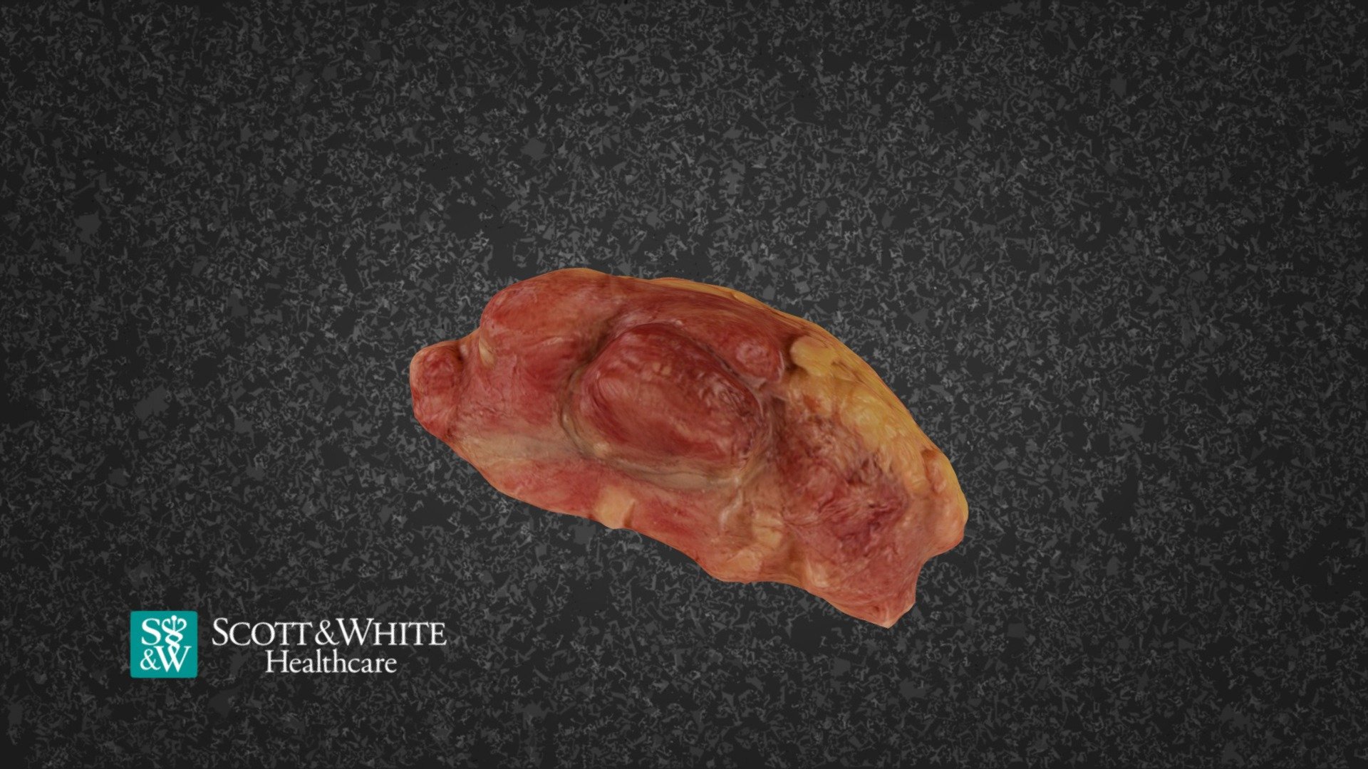 Leg- Fibrosarcoma 169140 - 3D model by Scott & White Moulage Project ...