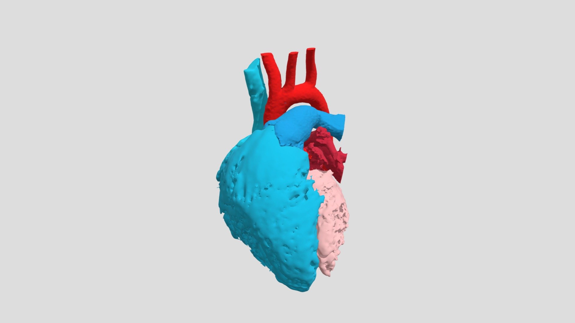 PAPVR, RV Enlargement, PV Stenosis (S0360) - 3D model by NCHS Cardiac ...