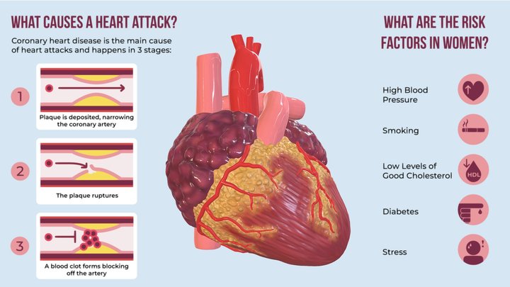 Heartattack 3D models - Sketchfab