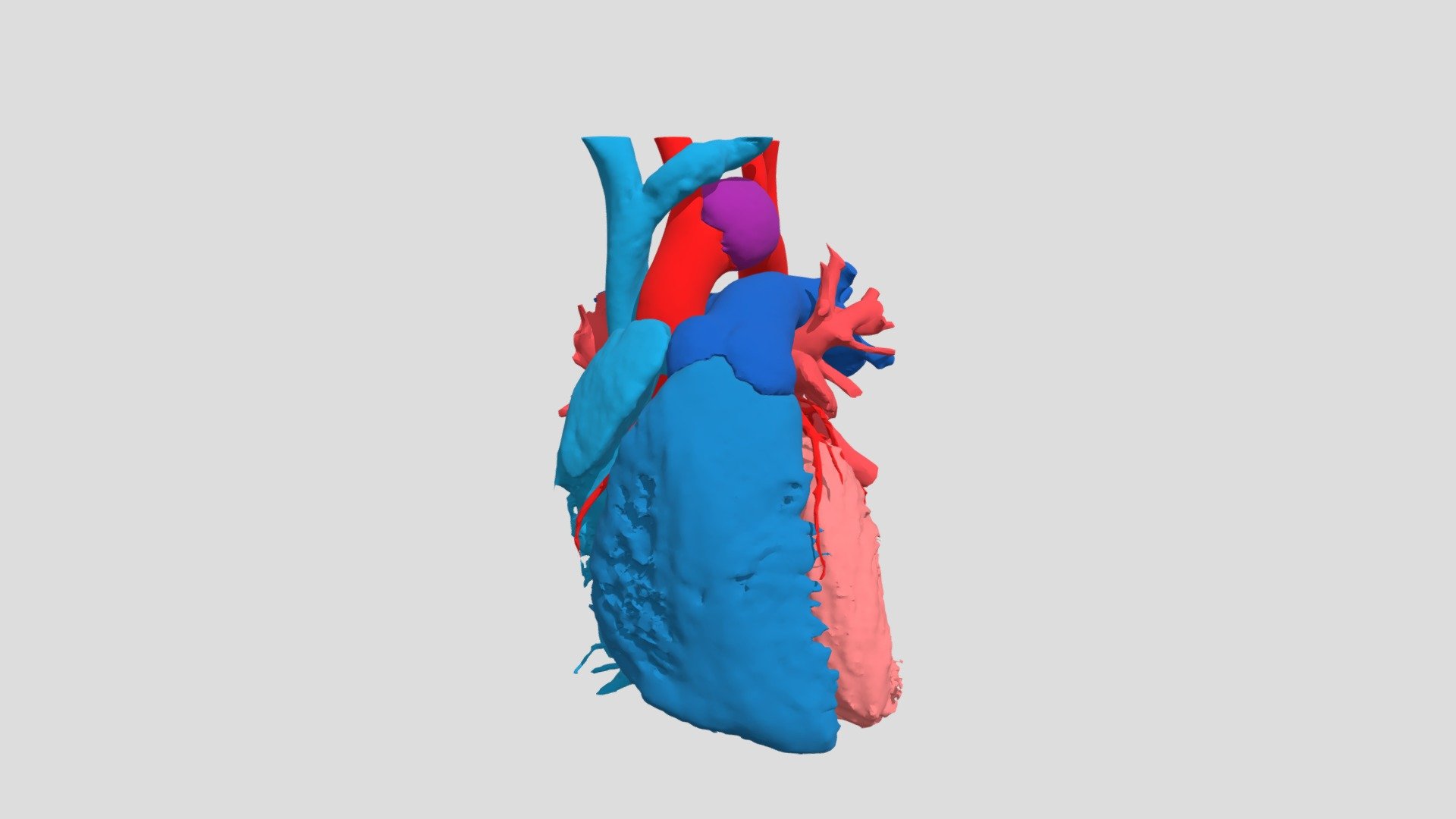 Thoracic Aortic Aneurysm (S0380) - 3D model by NCHS Cardiac Advanced ...