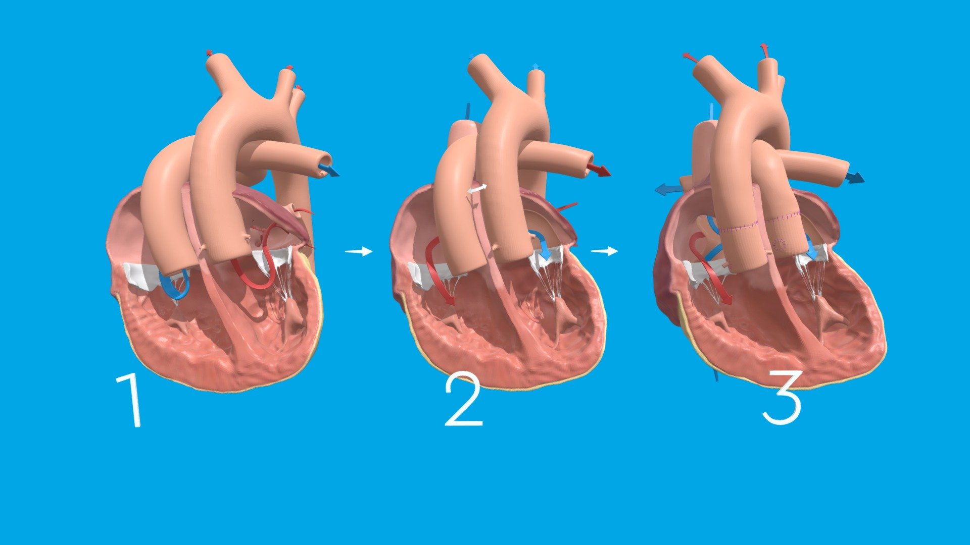 Double Switch Procedure - 3D model by Children's Hospital Colorado ...