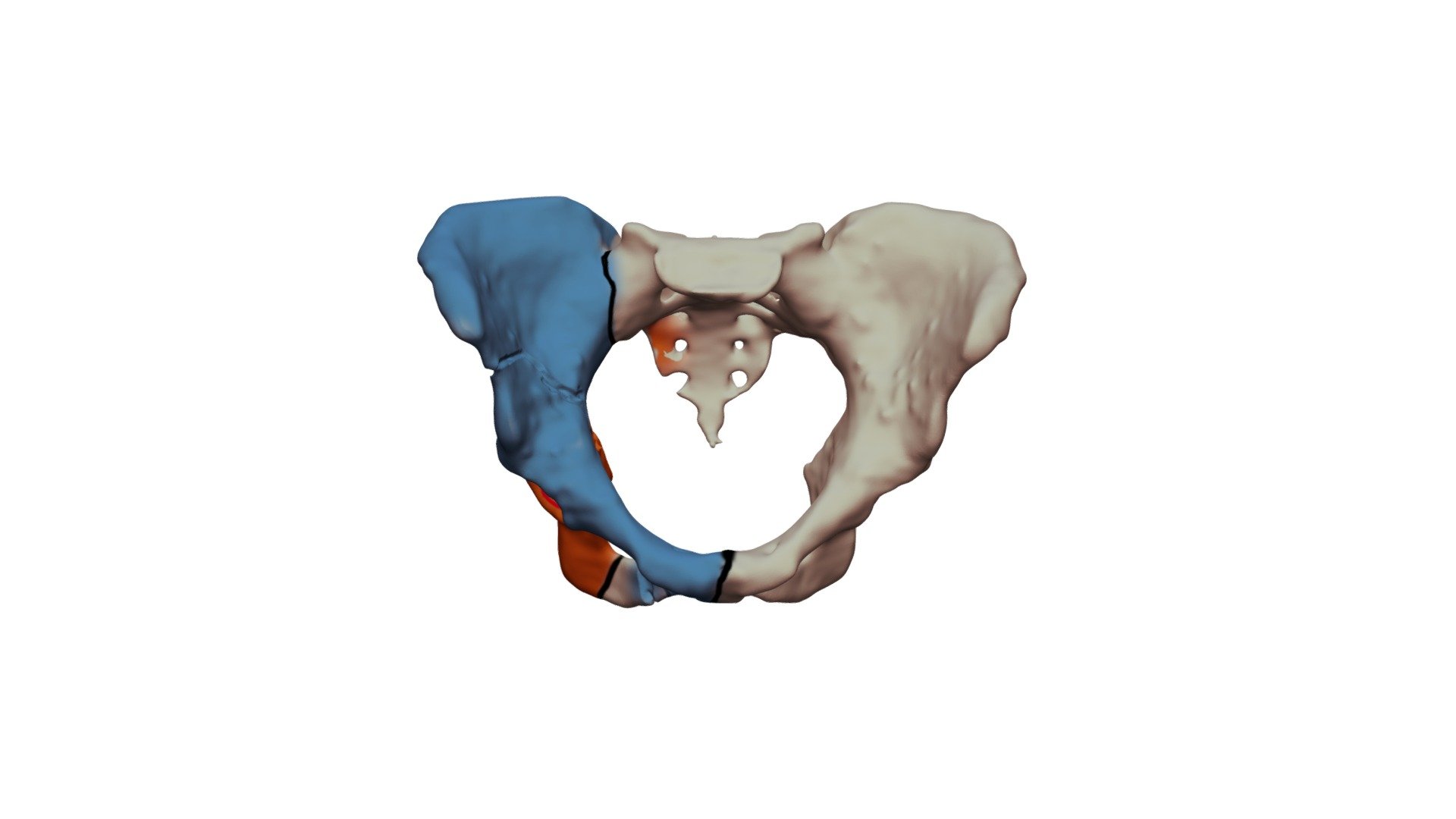 Anterior Column Posterior Hemitransverse - 3D model by nebosman ...