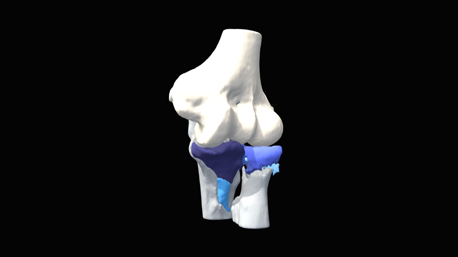 Session 3.3 | Elbow dislocation – ExFix vs Brace - Download Free 3D ...