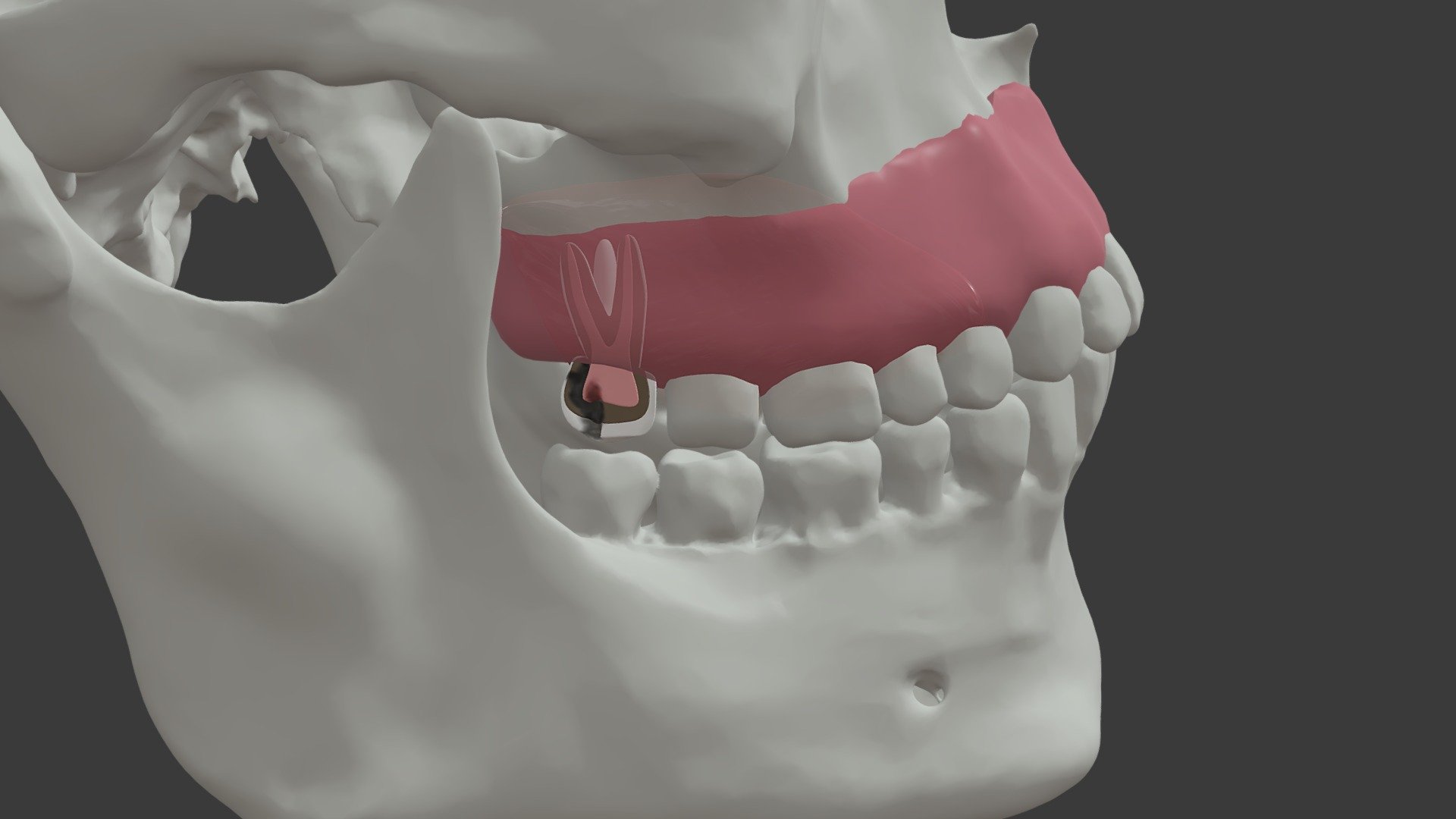 Stage 2 Long Root-Maxillary Sinusitis - 3D model by University of ...